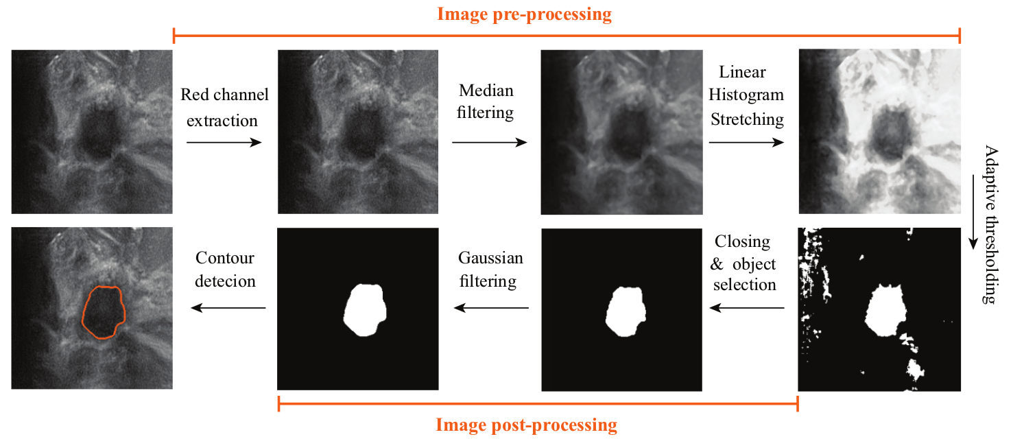 Segmentation and three-dimensional reconstruction of lesions using the ... Segmentation and three-dimensional reconstruction of lesions using the ...