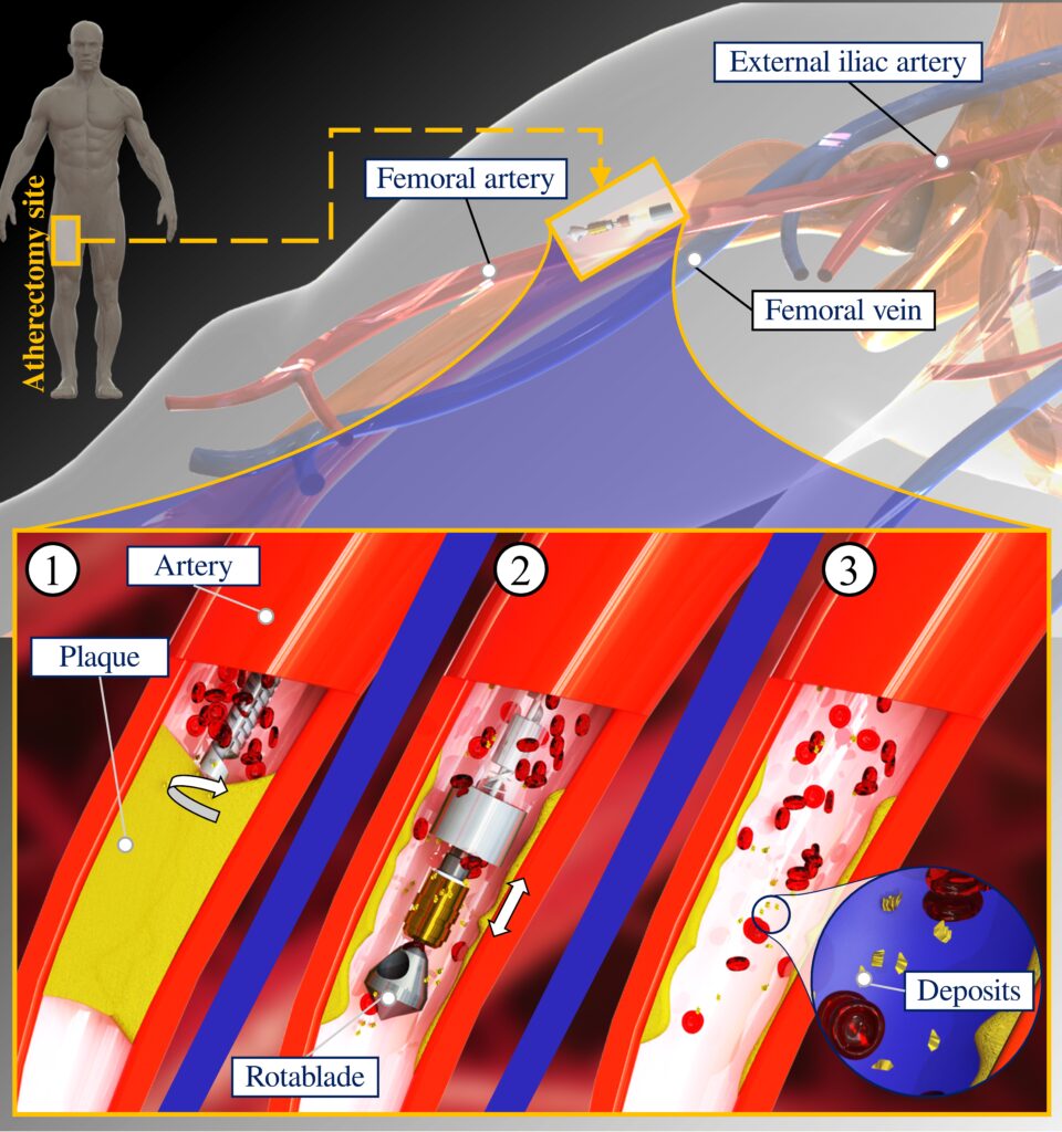 Design and evaluation of a magnetic rotablation catheter for arterial ...
